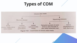 "Chronic Otitis Media: Understanding Squamousal Type CSOM and Its ...