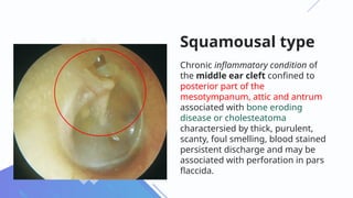 "Chronic Otitis Media: Understanding Squamousal Type CSOM and Its ...
