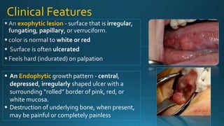 Squamous cell carcinoma | PPTX