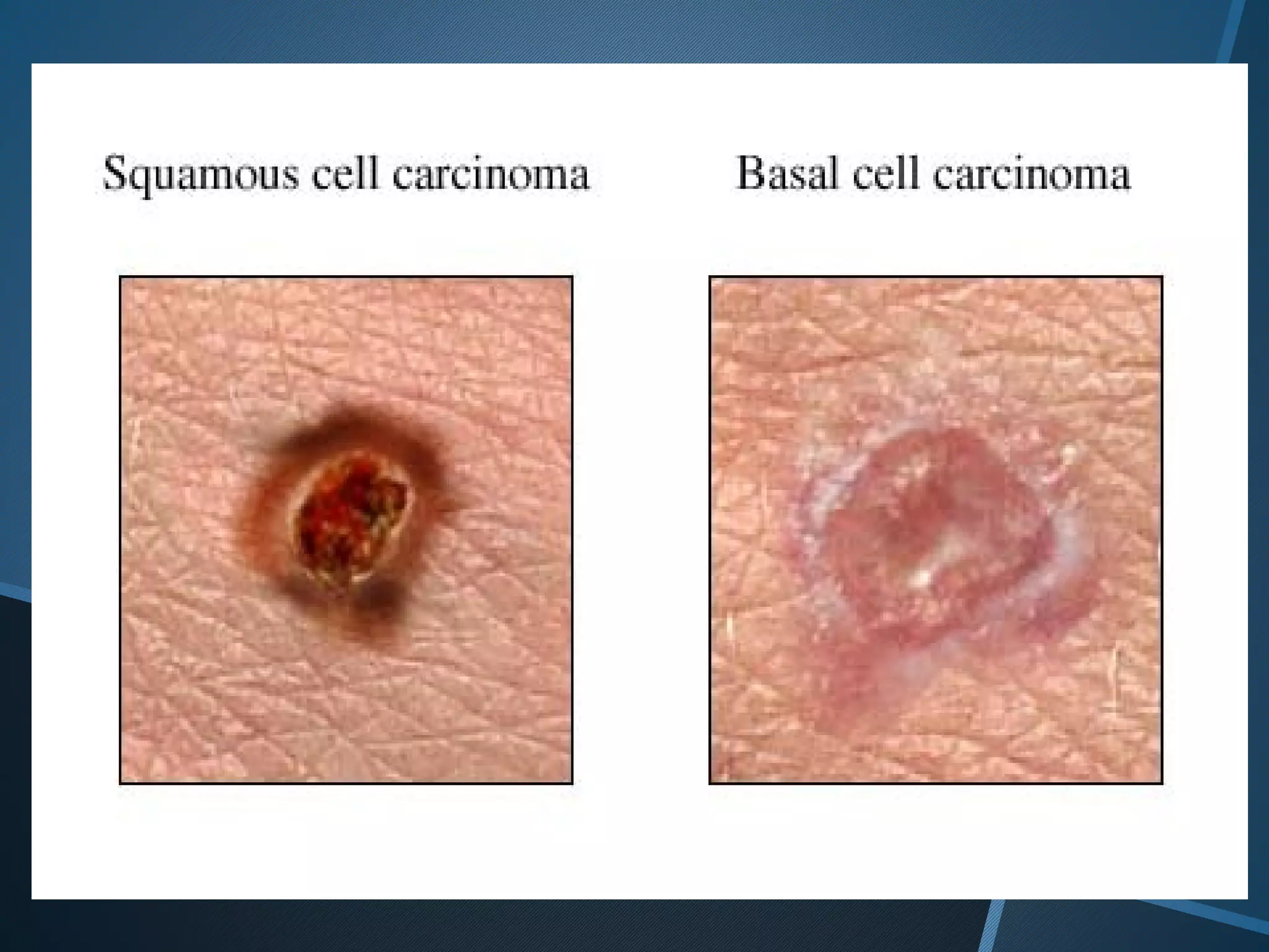 Squamous Cell Carcinoma by Dr. Ashfaq Afridi | PPT