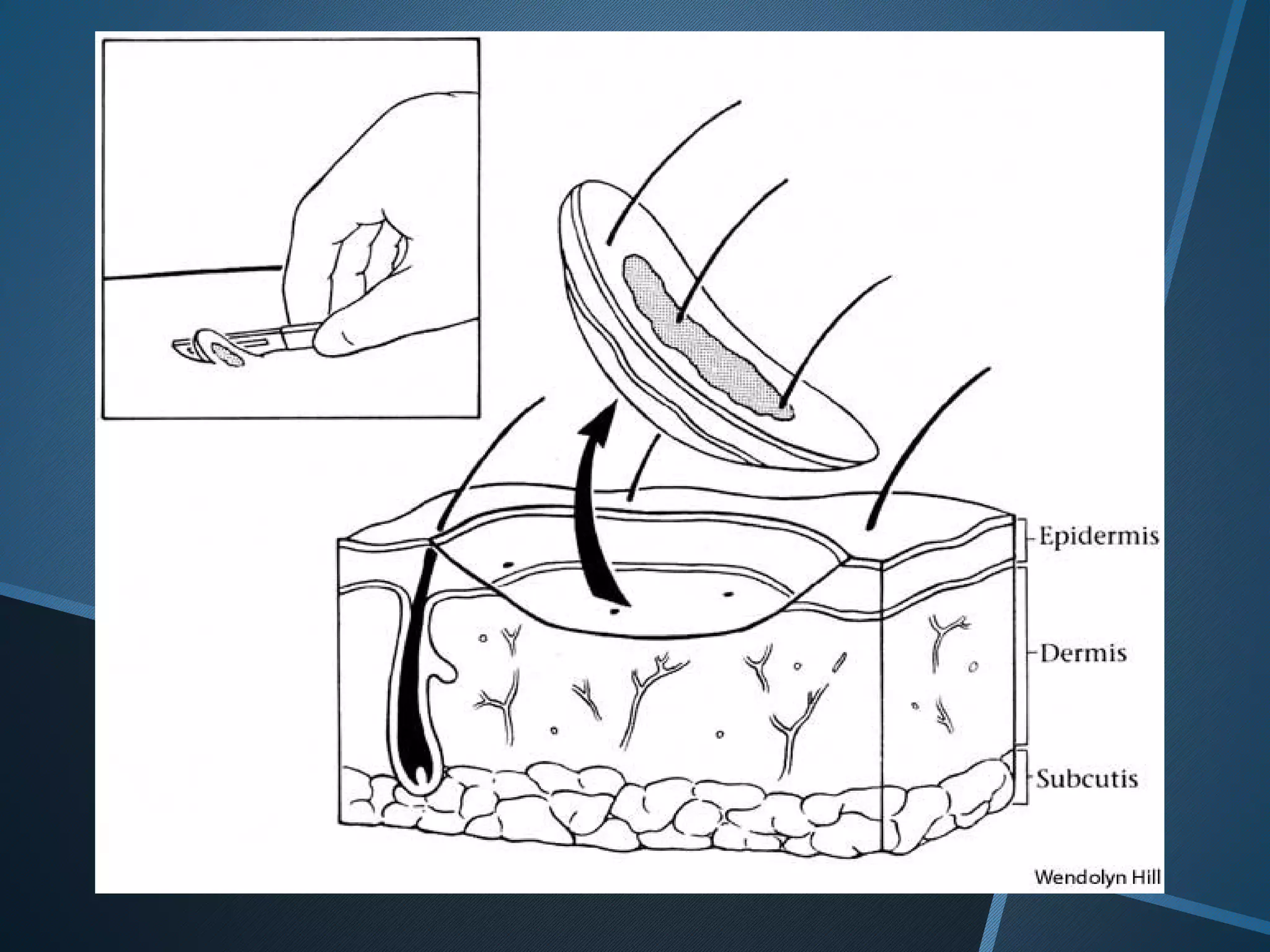 Squamous Cell Carcinoma by Dr. Ashfaq Afridi | PPT