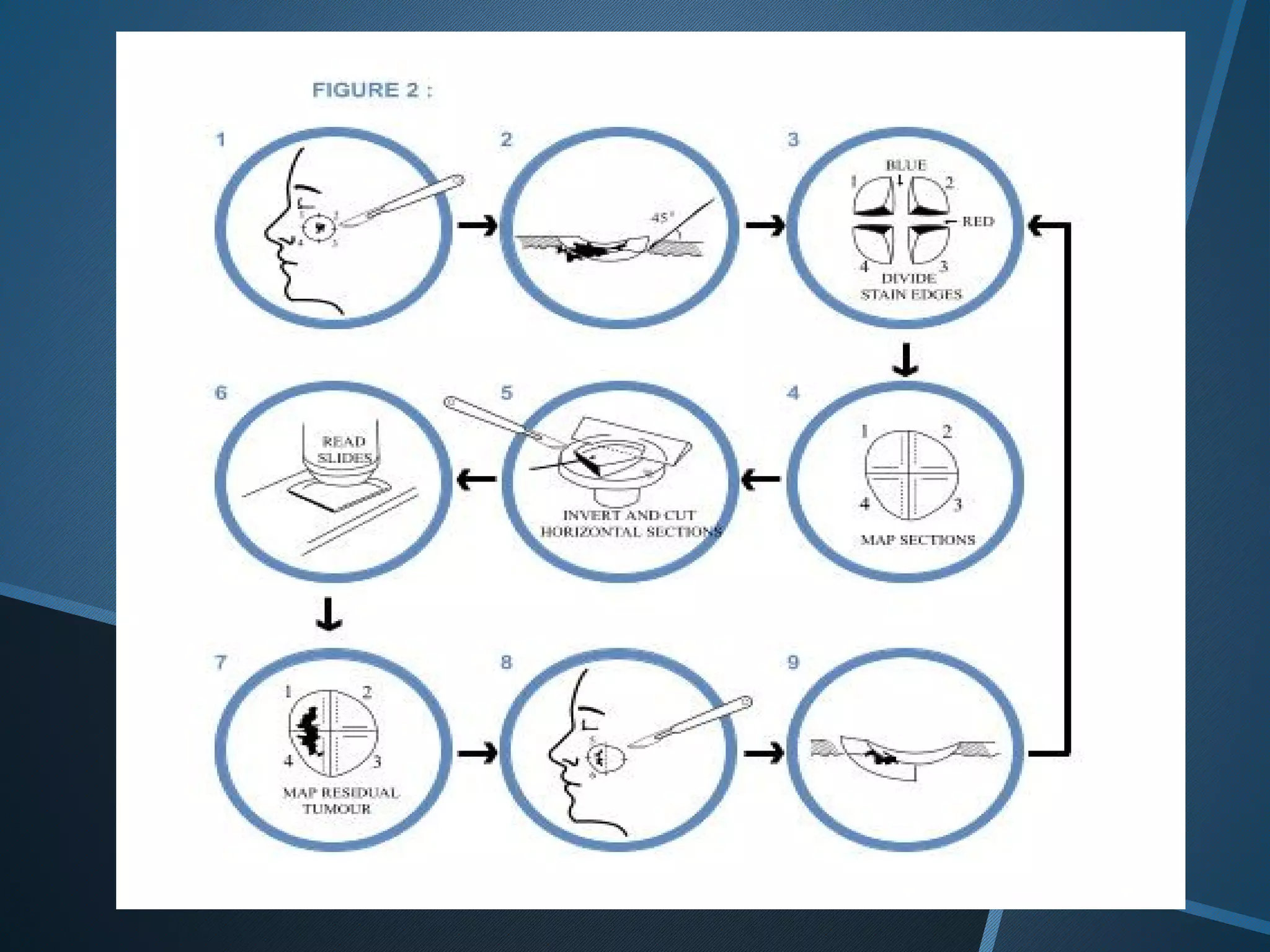 Squamous Cell Carcinoma by Dr. Ashfaq Afridi | PPT