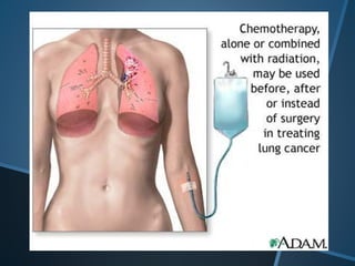 Squamous Cell Carcinoma by Dr. Ashfaq Afridi | PPT