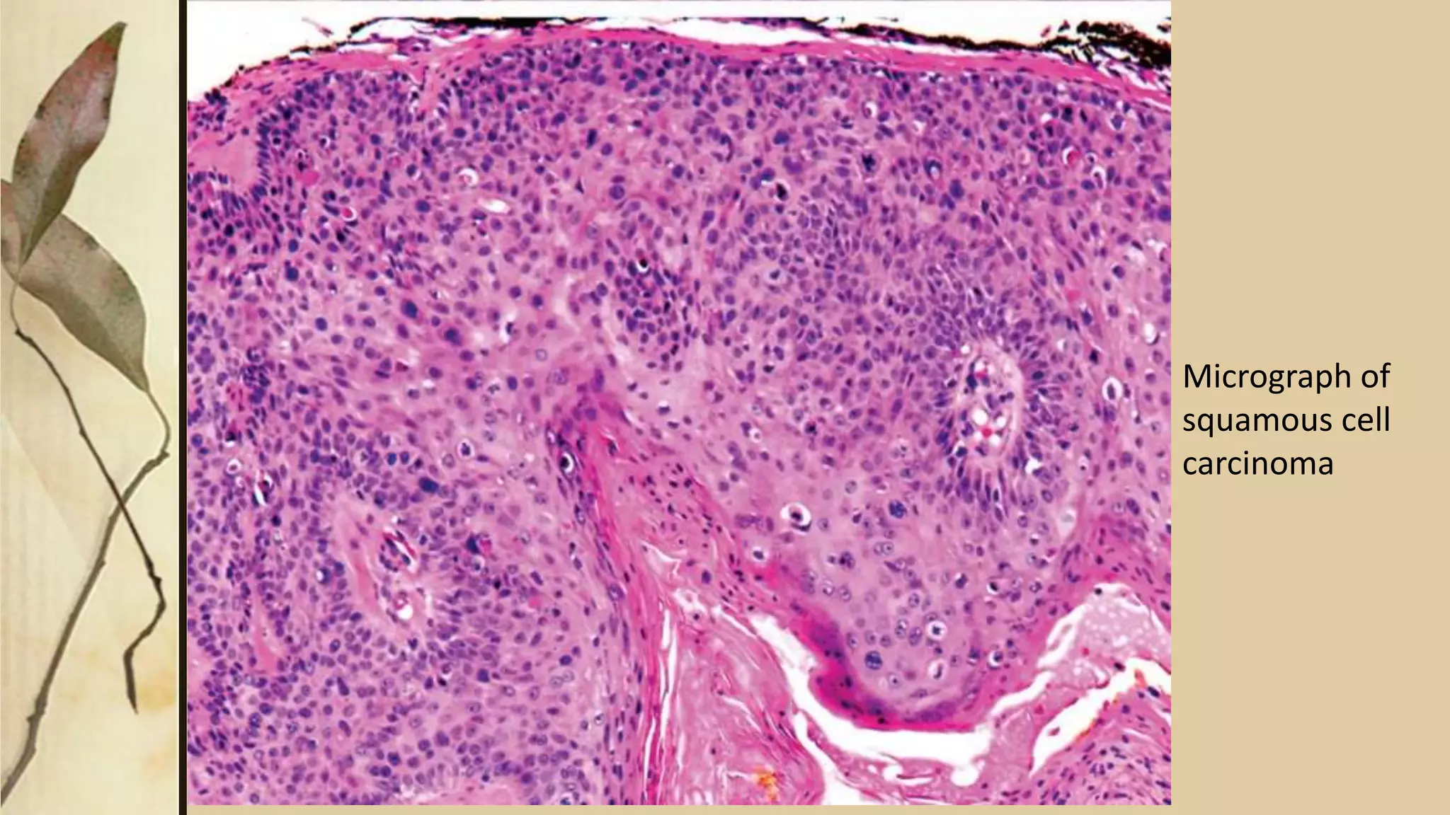 Squamous cell carcinoma of skin | management -all medical aspects. | PPTX