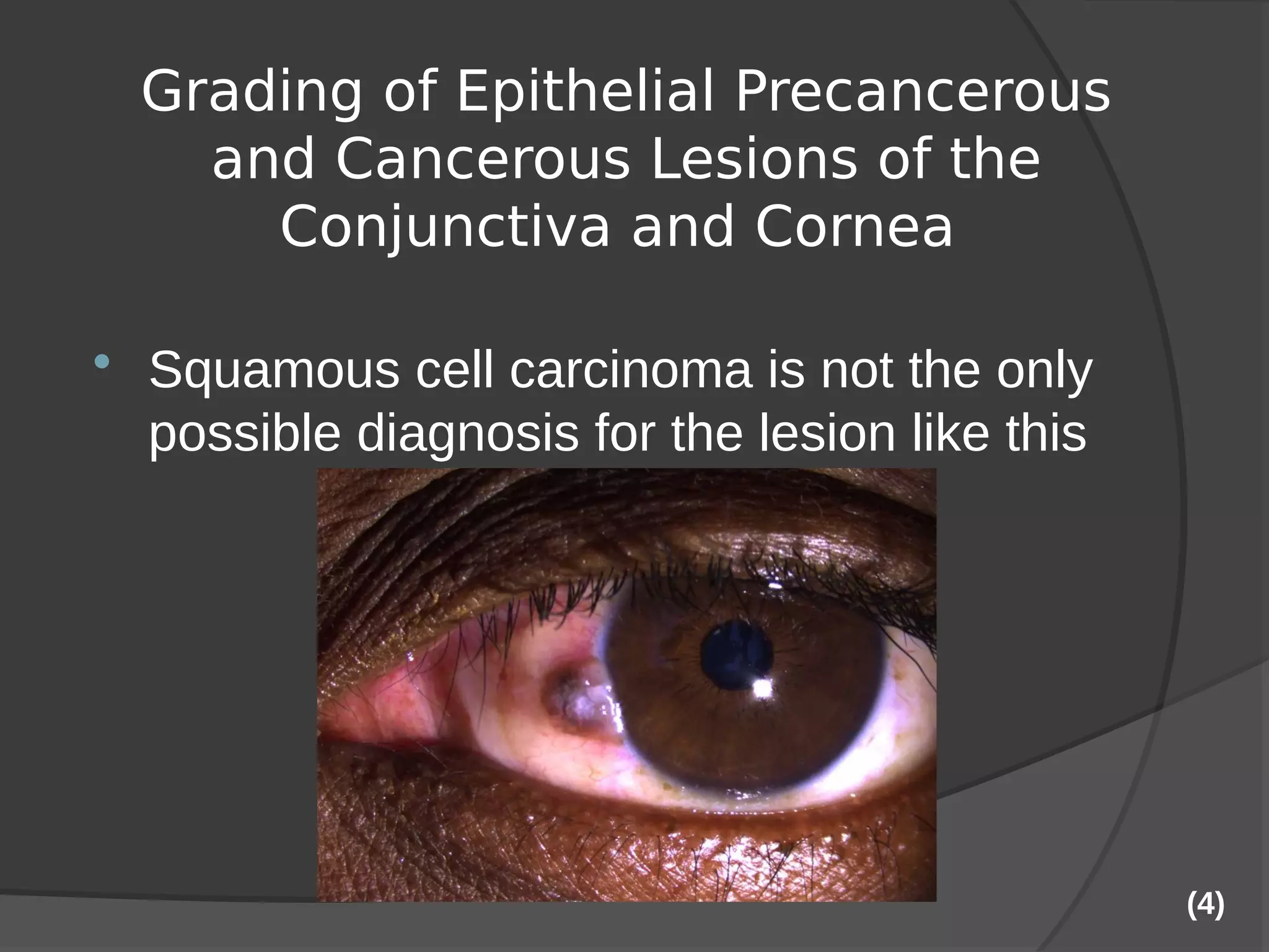 Conjunctival Squamous Cell Carcinoma | PDF