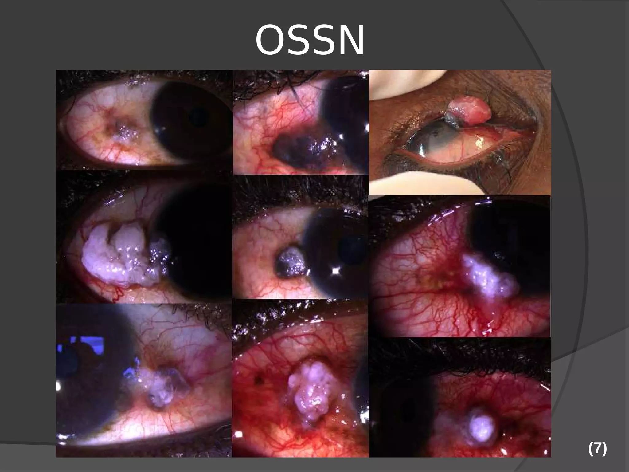 Conjunctival Squamous Cell Carcinoma Pdf