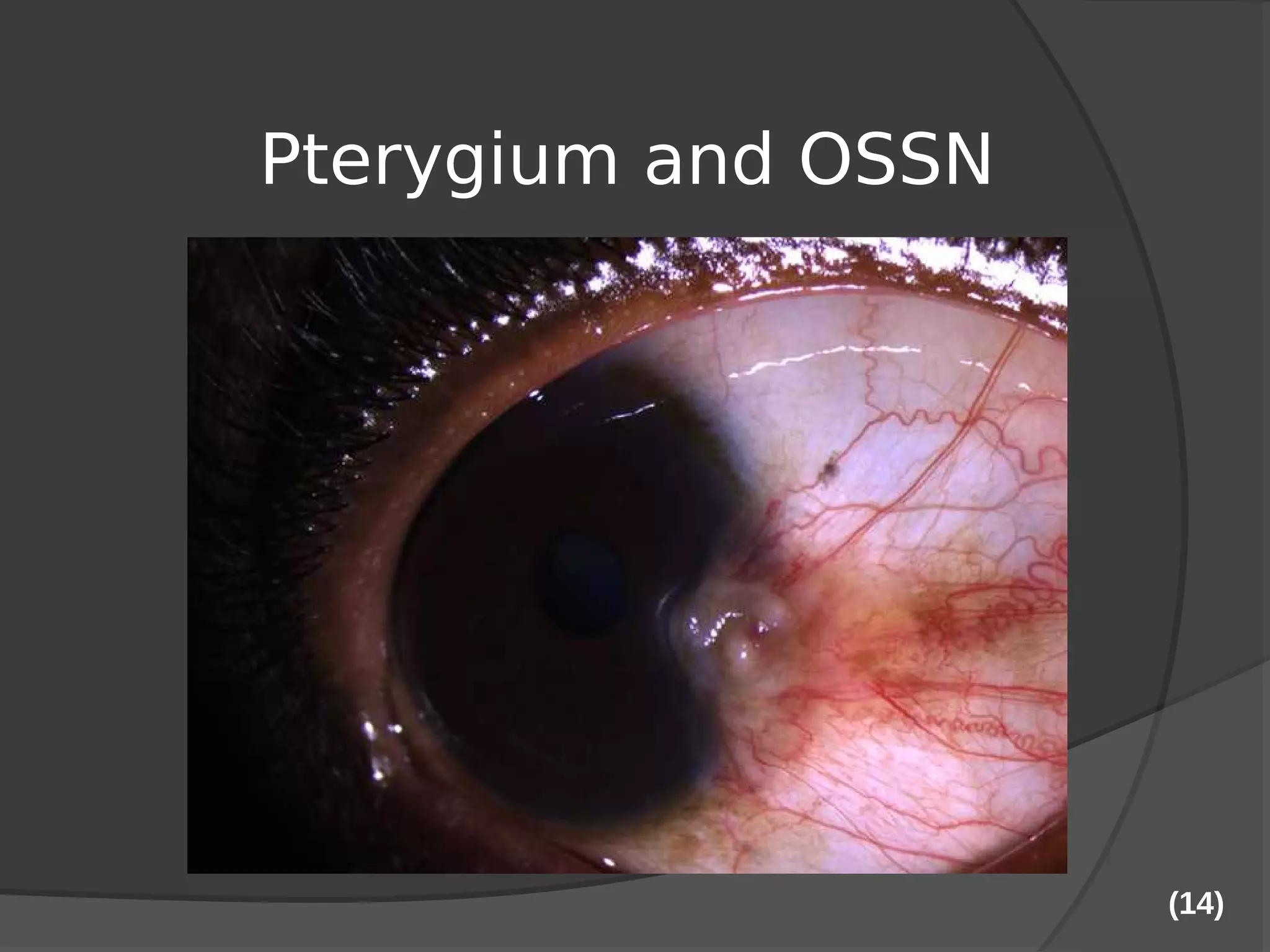 Conjunctival Squamous Cell Carcinoma | PDF