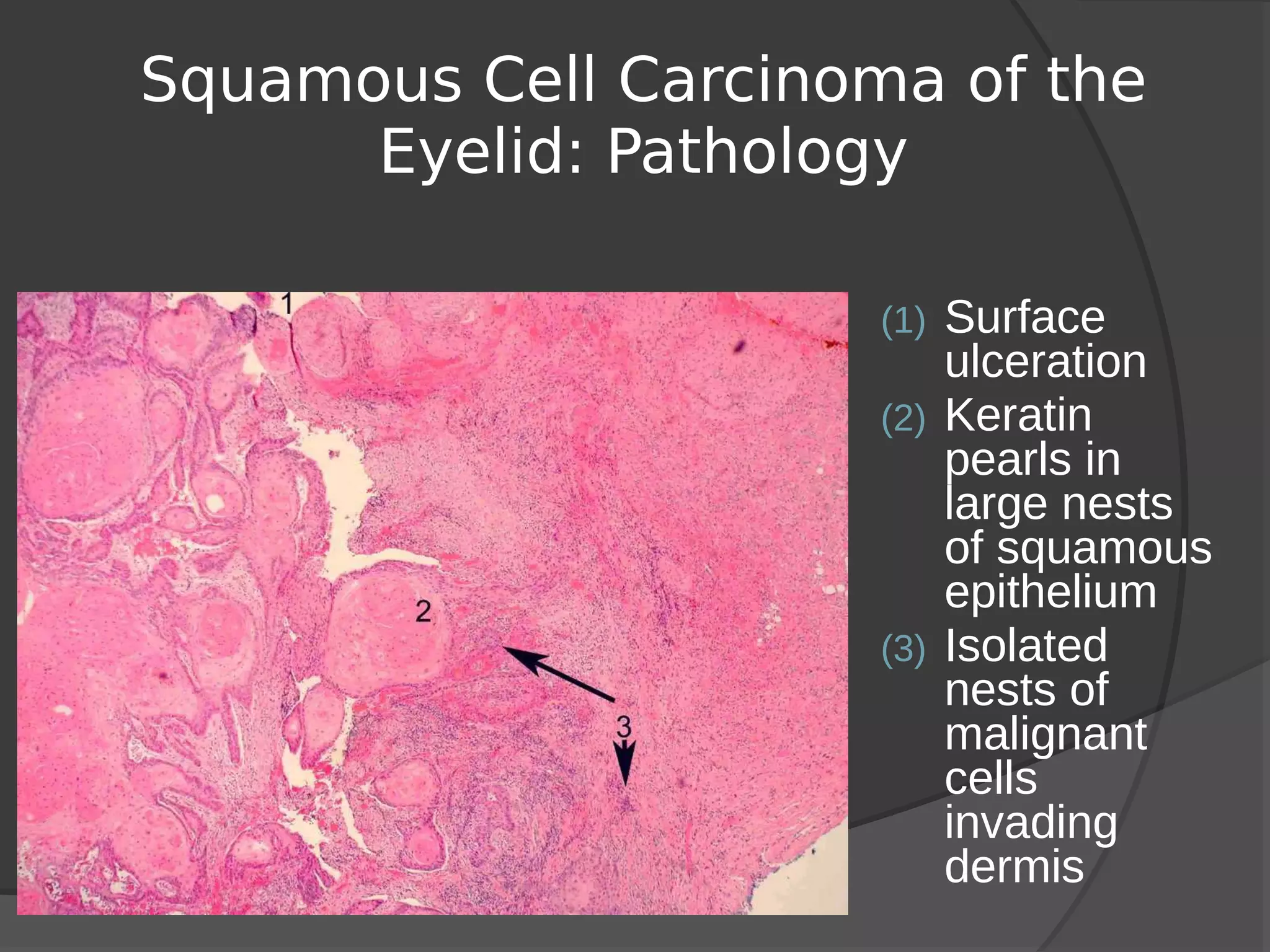 Conjunctival Squamous Cell Carcinoma | PDF