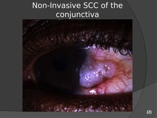 Conjunctival Squamous Cell Carcinoma | PDF