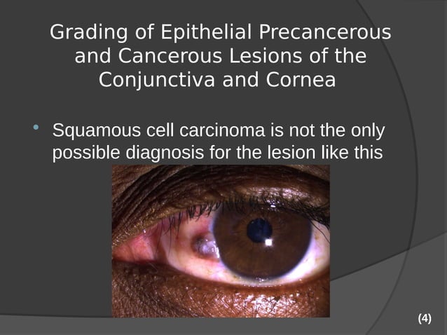 Conjunctival Squamous Cell Carcinoma | PDF | Eye and Vision Conditions ...