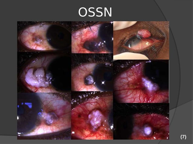 Conjunctival Squamous Cell Carcinoma | PDF | Eye and Vision Conditions ...