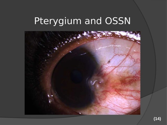 Conjunctival Squamous Cell Carcinoma | PDF | Eye and Vision Conditions ...