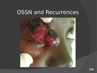 Conjunctival Squamous Cell Carcinoma | PDF