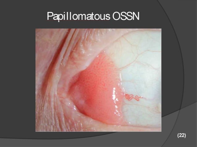 Conjunctival Squamous Cell Carcinoma | PDF | Eye and Vision Conditions ...