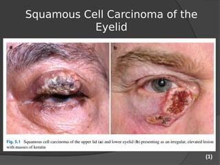 Conjunctival Squamous Cell Carcinoma | PDF