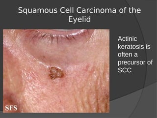 Conjunctival Squamous Cell Carcinoma | PDF