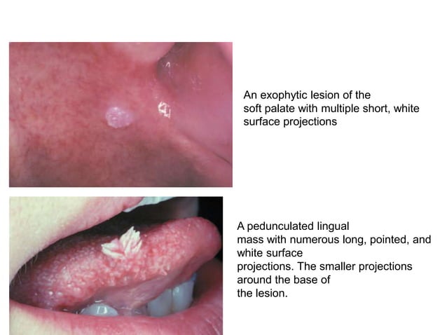 Squamous papilloma | PPTX | Ear, Nose and Throat Conditions | Diseases ...