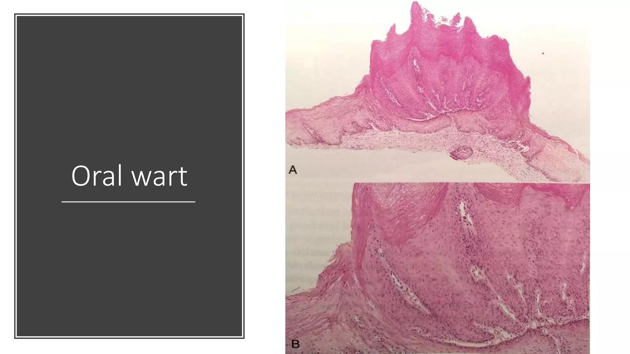 Squamous Papilloma and Verruciform Xanthoma (Doctor Faris Alabeedi MSc ...