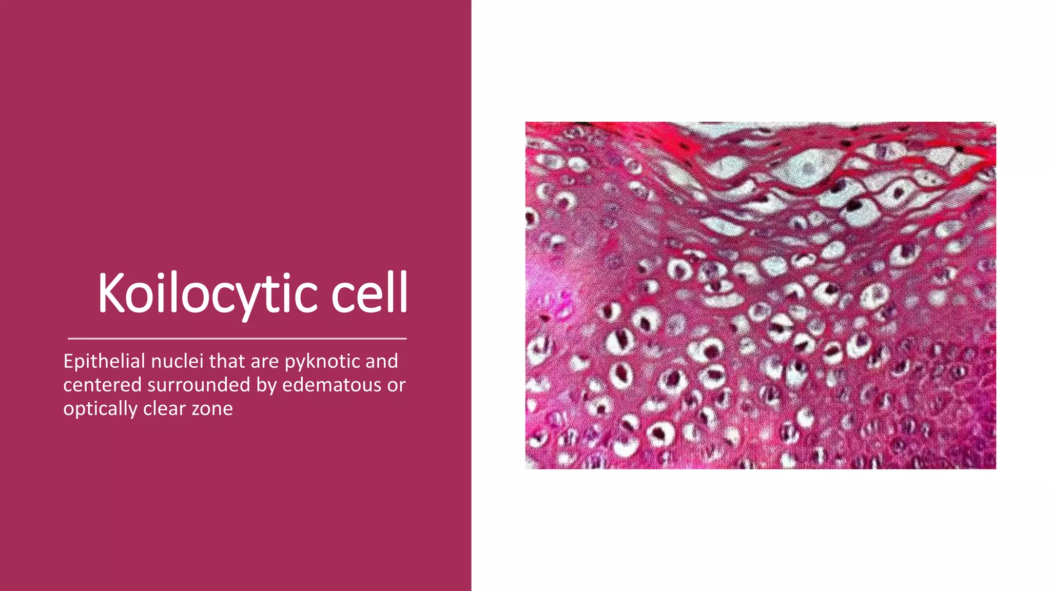 Squamous Papilloma and Verruciform Xanthoma (Doctor Faris Alabeedi MSc ...