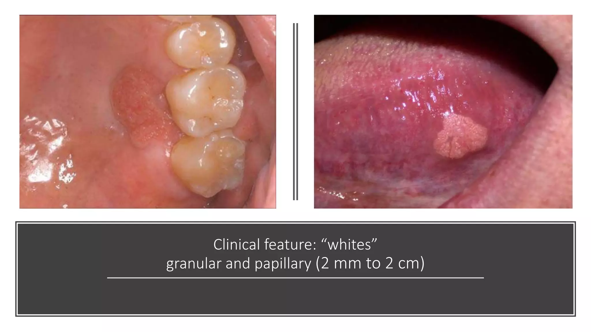 Squamous Papilloma and Verruciform Xanthoma (Doctor Faris Alabeedi MSc ...