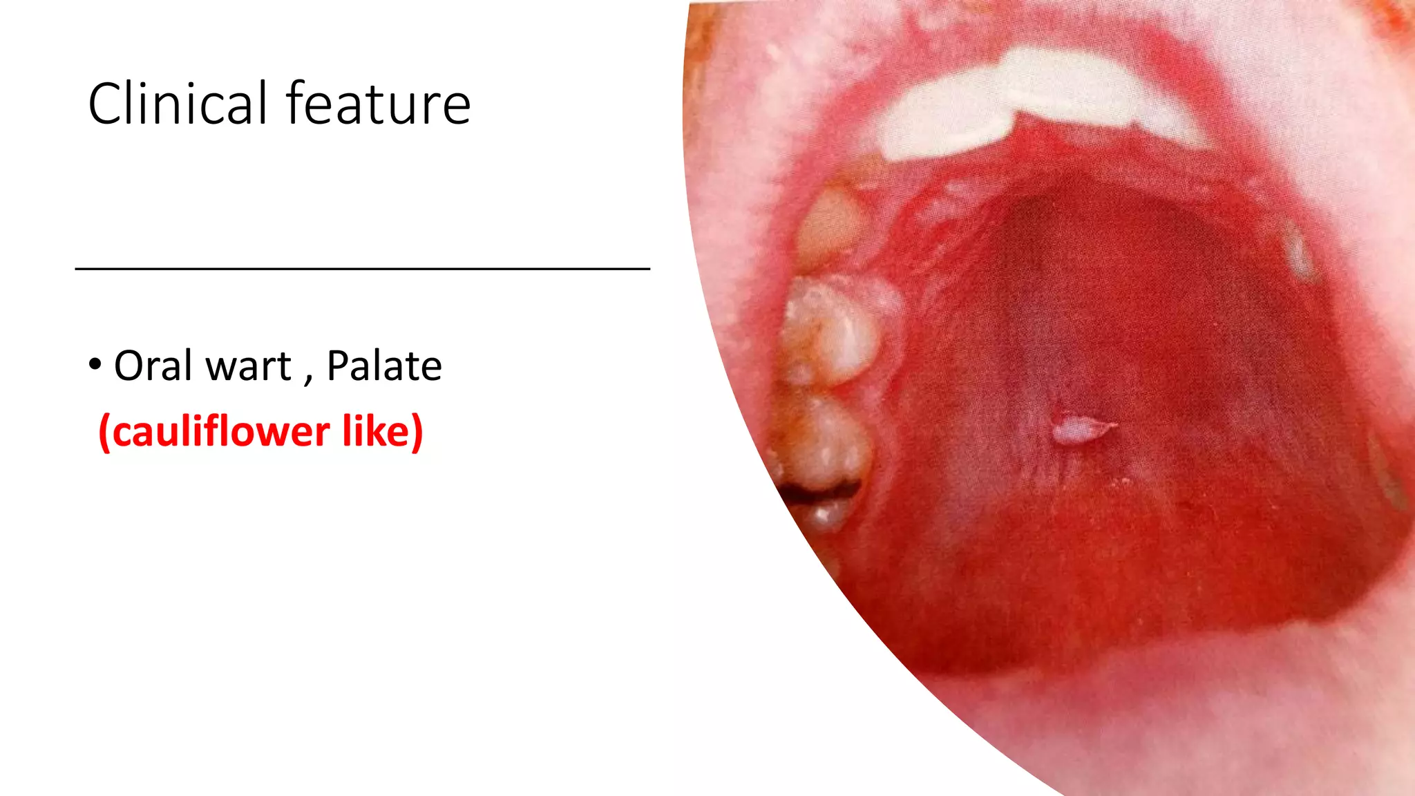 Squamous Papilloma and Verruciform Xanthoma (Doctor Faris Alabeedi MSc ...