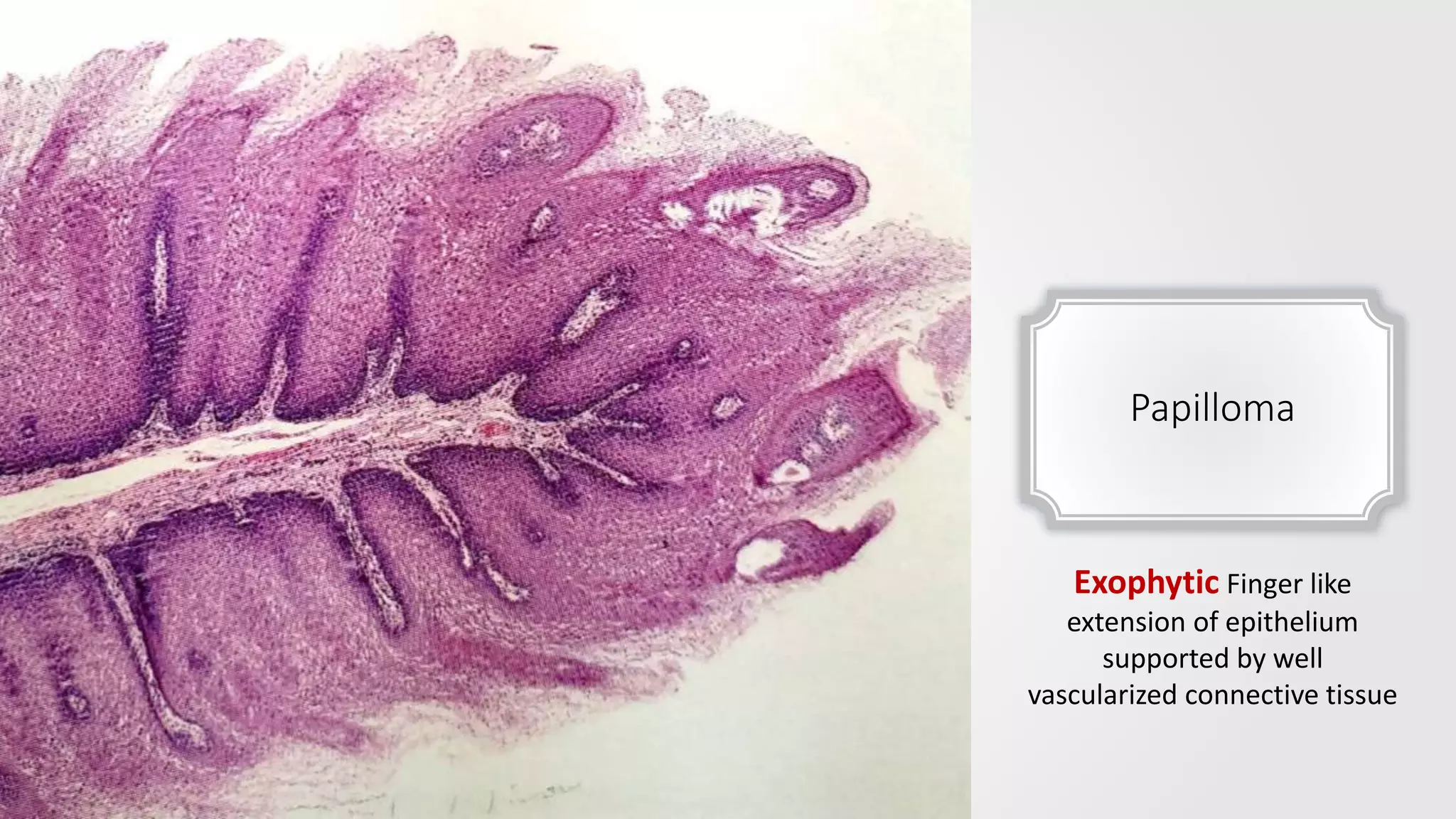 Squamous Papilloma and Verruciform Xanthoma (Doctor Faris Alabeedi MSc ...