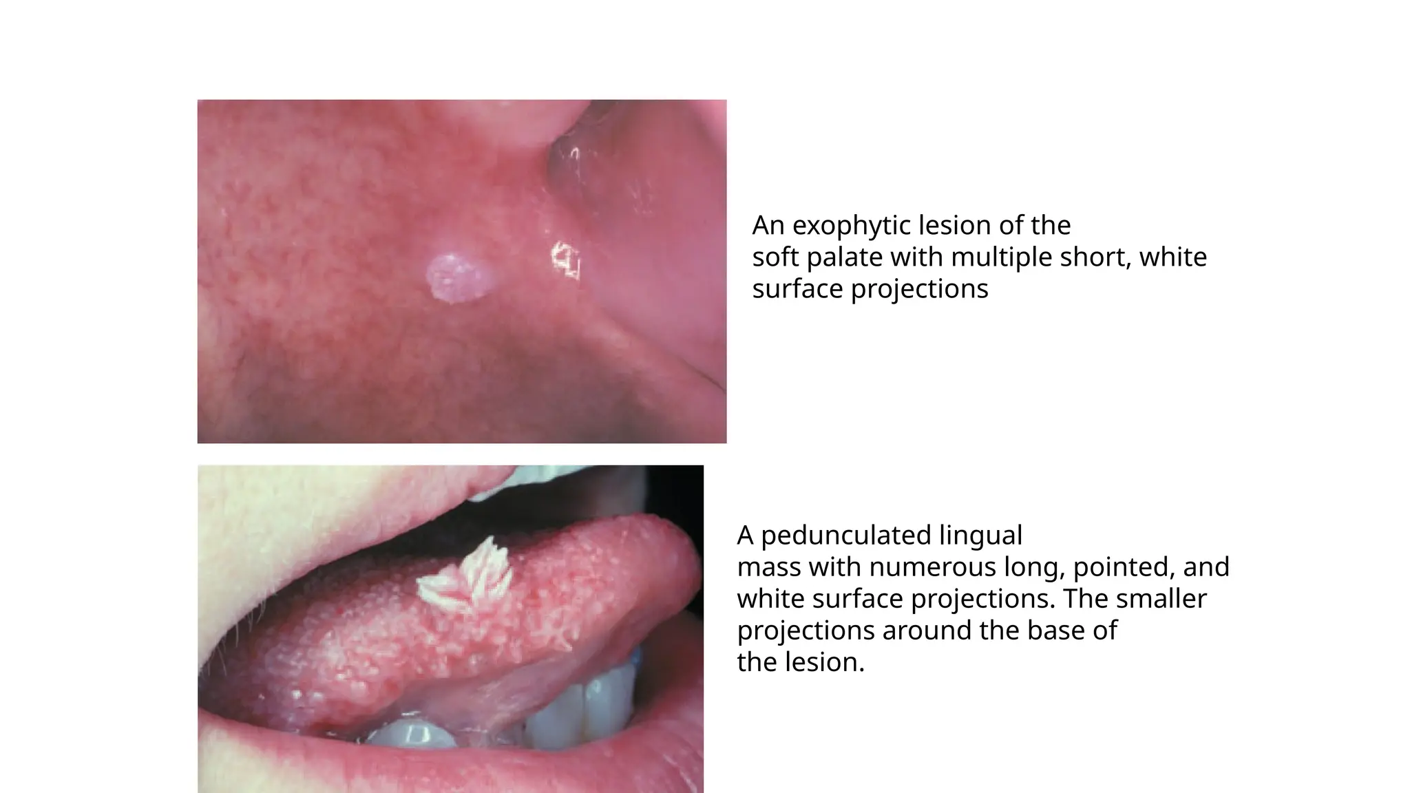 SQUAMOUS PAPILLOMA.pathology bds practical pptx | PPTX