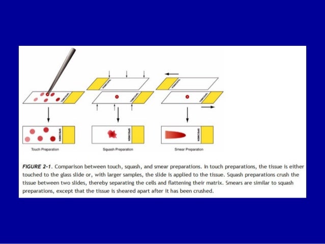 Squash cytology of cns paediatric tumours