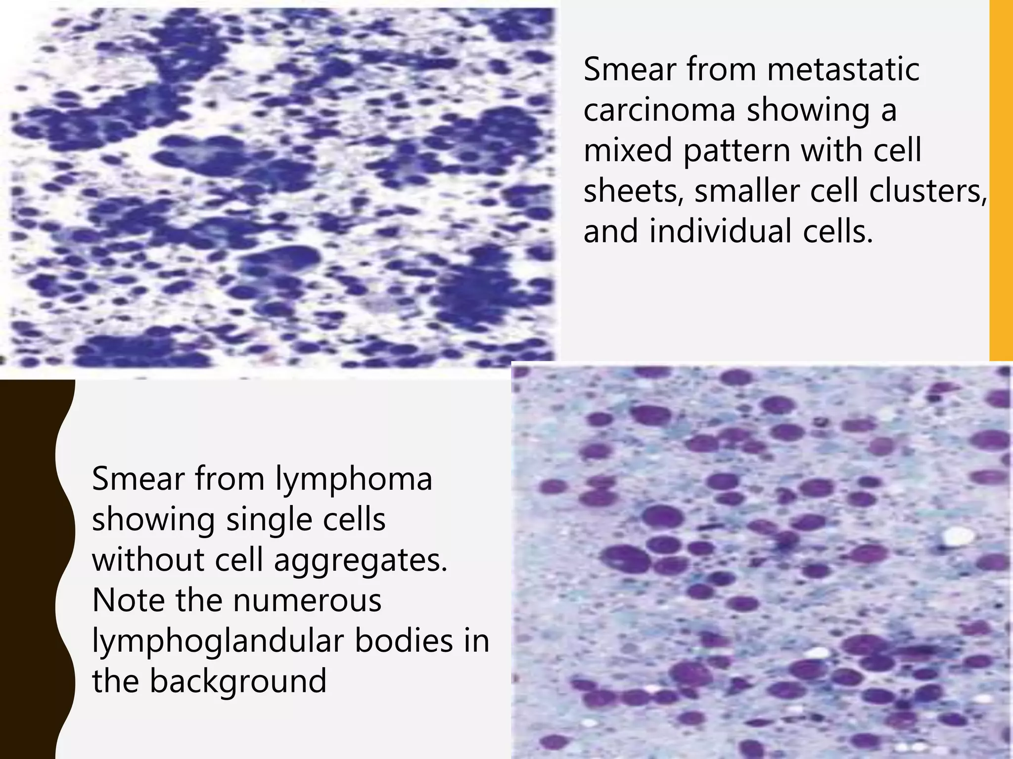 Squash smear cytology - By Anamika dev | PPTX