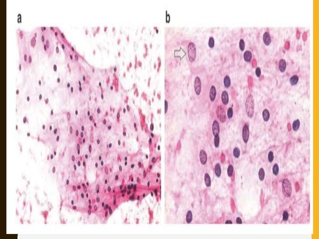 Squash smear cytology - By Anamika dev | PPTX