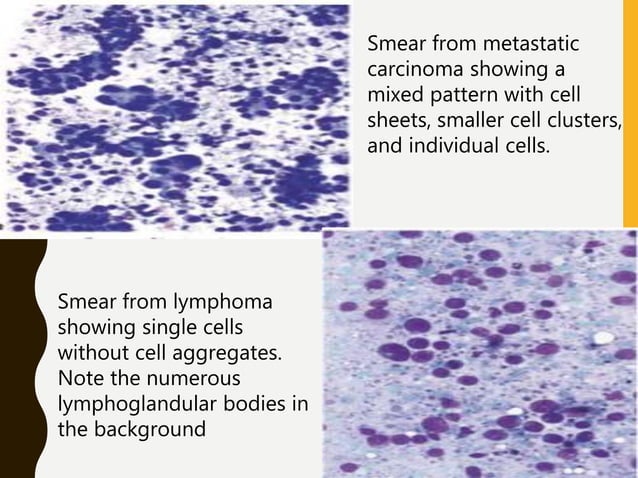 Squash smear cytology - By Anamika dev | PPTX