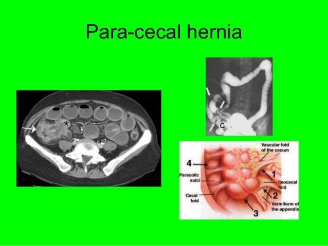 Squeezed through holes: imaging of internal hernia