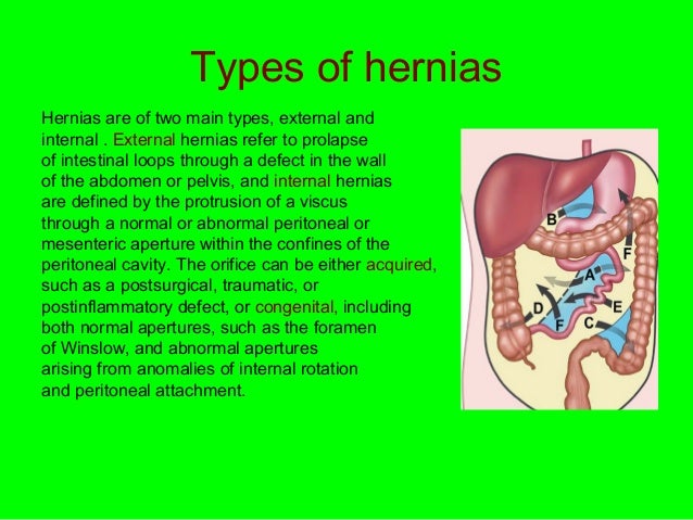 Different Types Of Hernia What Type Of Hernia Do I Have Hernia Clinic
