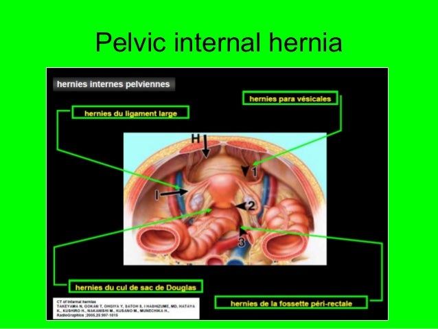 Squeezed through holes: imaging of internal hernia
