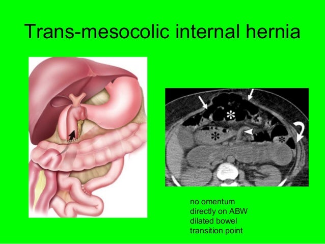 Squeezed through holes: imaging of internal hernia