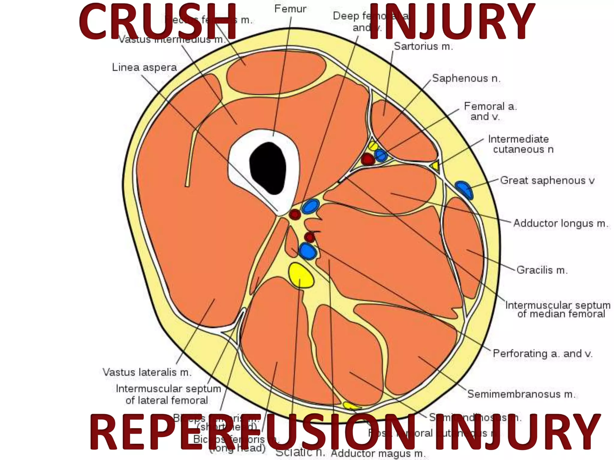 Squeeze Play: Compartment Syndrome, Crush Injury & Rhabdomyolosis ...