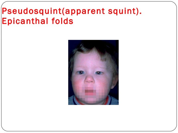 Ophthalmology 5th year, 5th lecture (Dr. Tara)