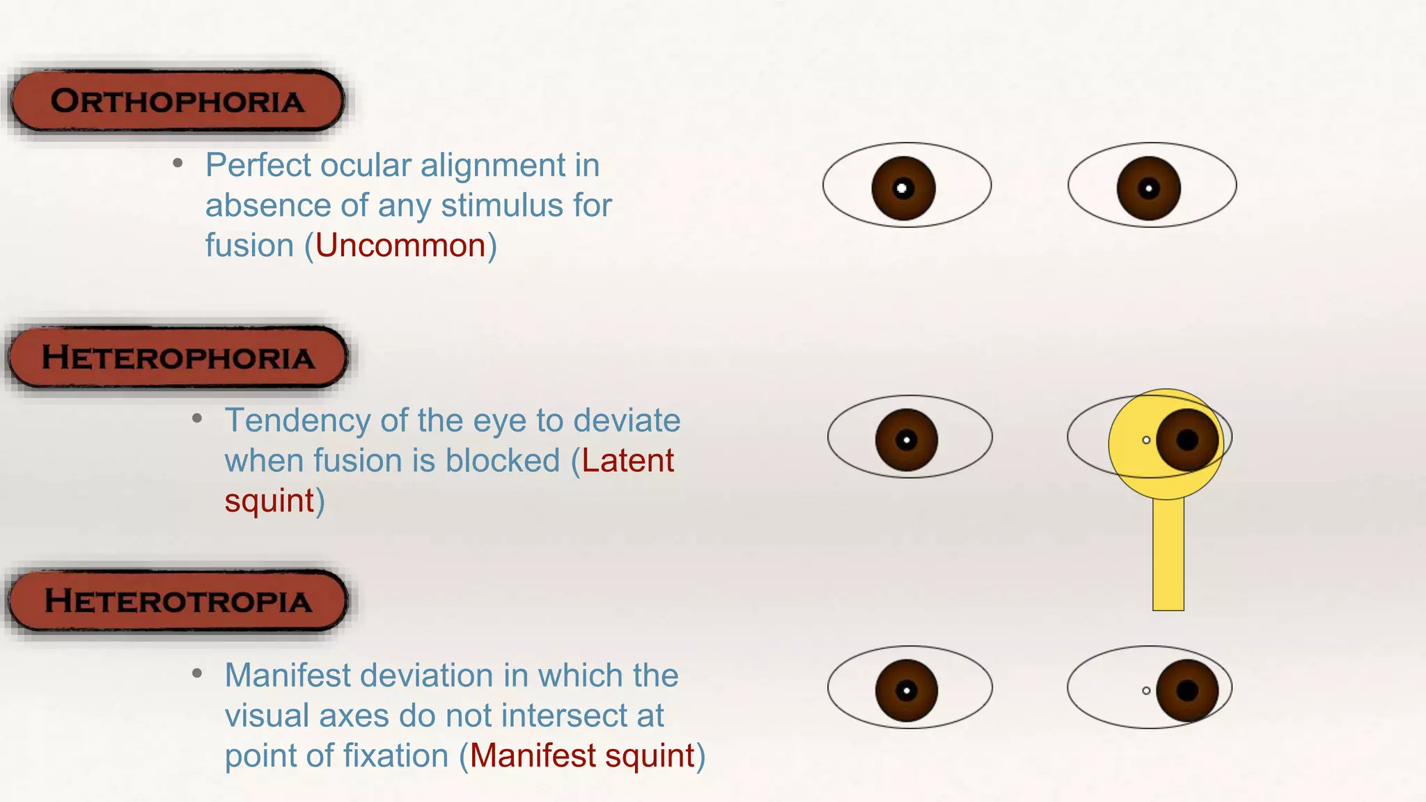 Squint (Anatomy, phsiology) | PPTX