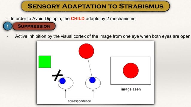 Squint (Anatomy, phsiology) | PPTX