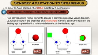 Squint (Anatomy, phsiology) | PPTX