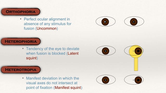 Squint (Anatomy, phsiology) | PPTX
