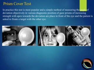 squint assessment optom Anamul haq | PPTX