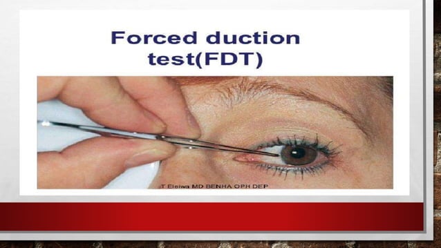 Squint assessment | PPTX