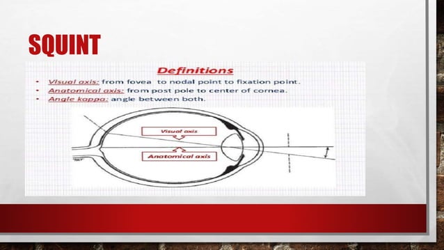 Squint assessment | PPTX