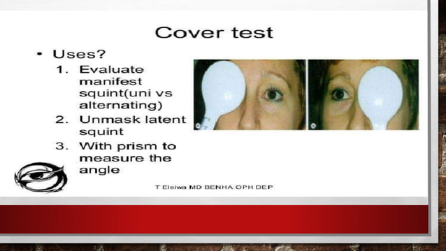 Squint assessment | PPTX