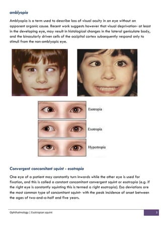 Squint esotropia | PDF