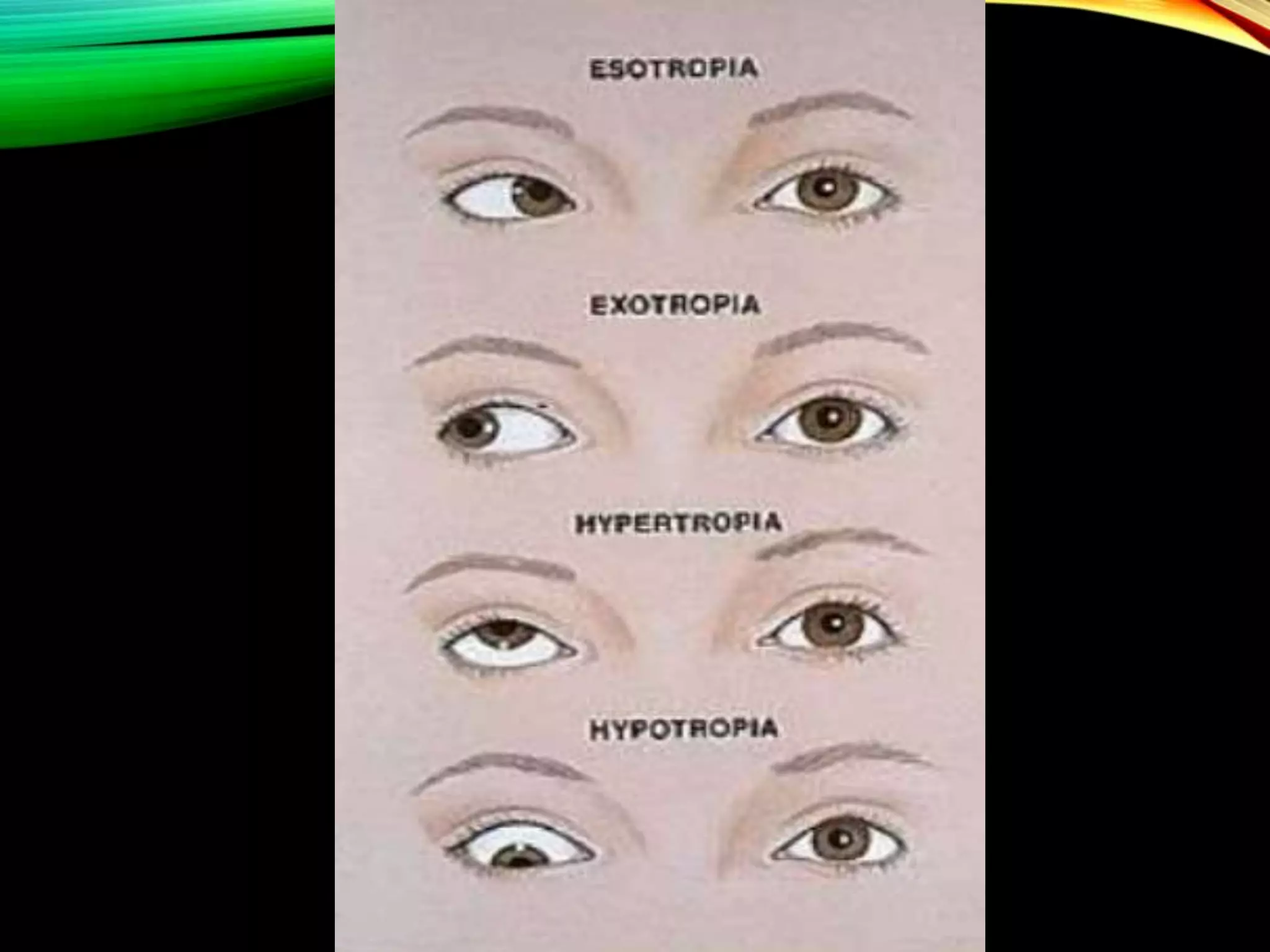 Clinical examination of squint | PPTX