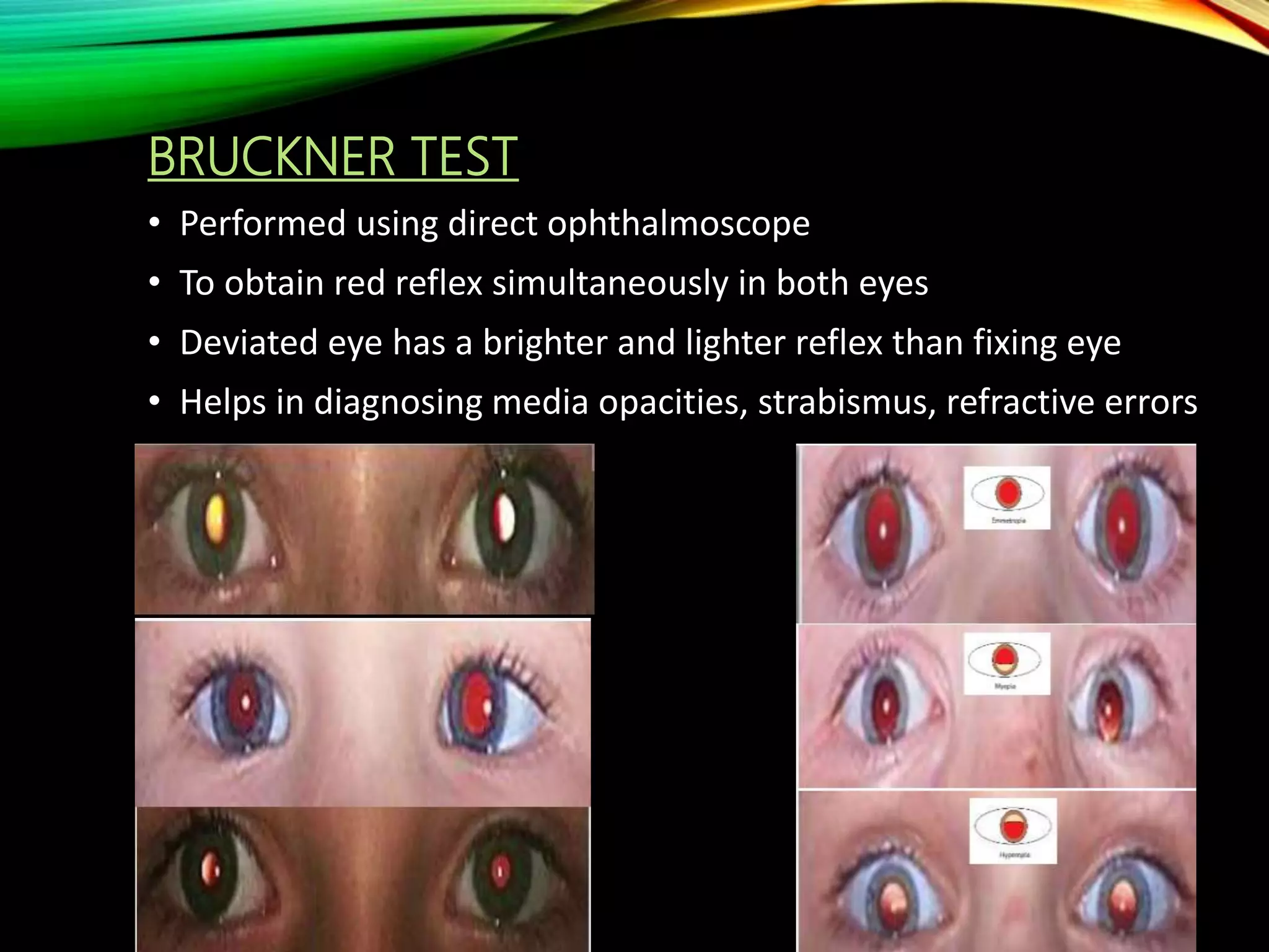 Clinical examination of squint | PPTX
