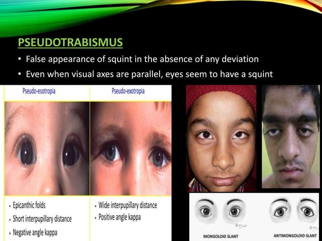 Clinical examination of squint | PPTX
