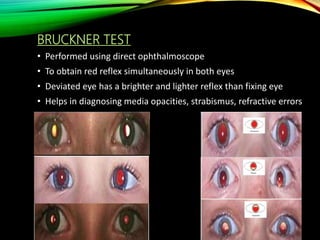 Clinical examination of squint | PPT